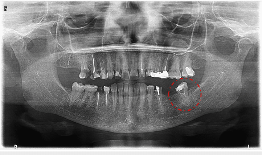O.P.G. (Orthopantomogram)